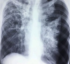 Experts call for new TB diagnostic innovations