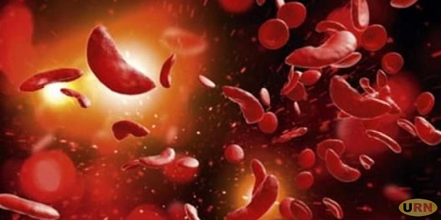 Nalufenya hospital registers 800 cases of sickle cell disease per month